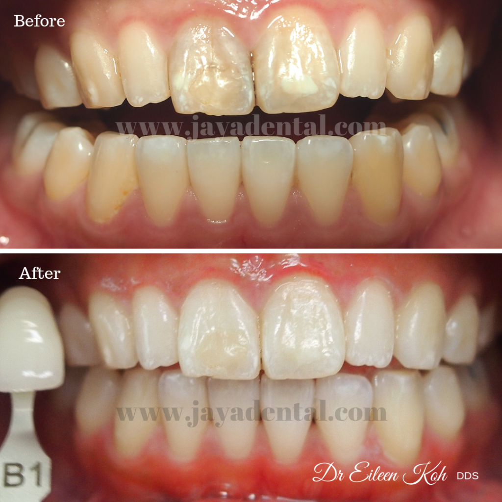 non-vital_-internal-bleaching - Jaya Dental Surgery